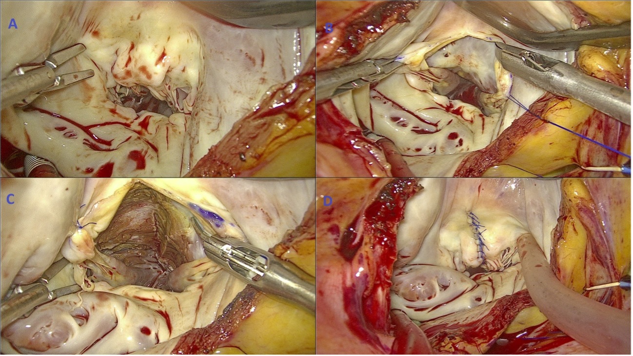 Longitudinal valvotomy of anterior leaflet for endoscopic transmitral ...