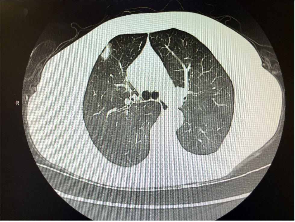 Video atlas of pulmonary segmentectomy: robotic-assisted right S3 segmentectomy with 3 ...