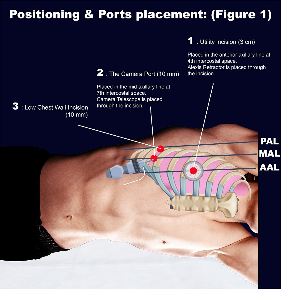 How to optimize your set-up for a VATS right upper lobectomy | MMCTS