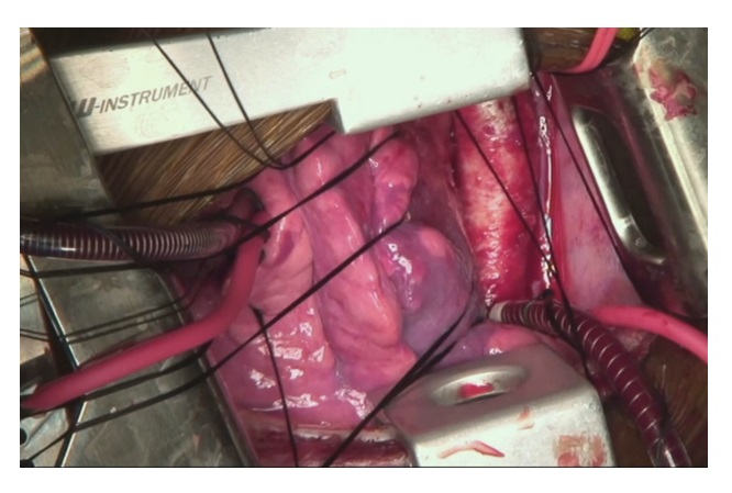 Left heart bypass for repair of aortic coarctation in children ...