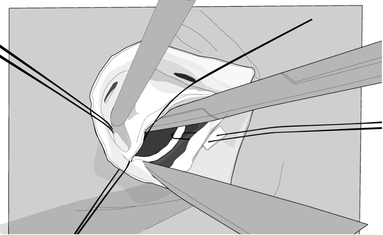 Functional aortic annulus 3-dimensional remodelling during bicuspid ...