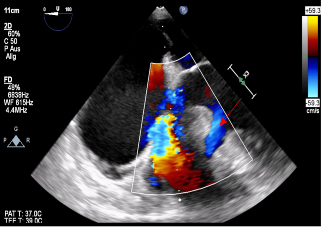 Transatrial repair of a ventricular septal defect and tricuspid valve ...
