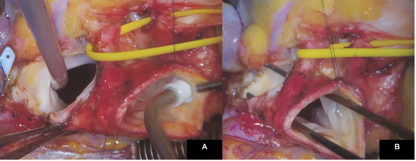 Resection and double pericardial patch repair of a congenital aneurysm ...