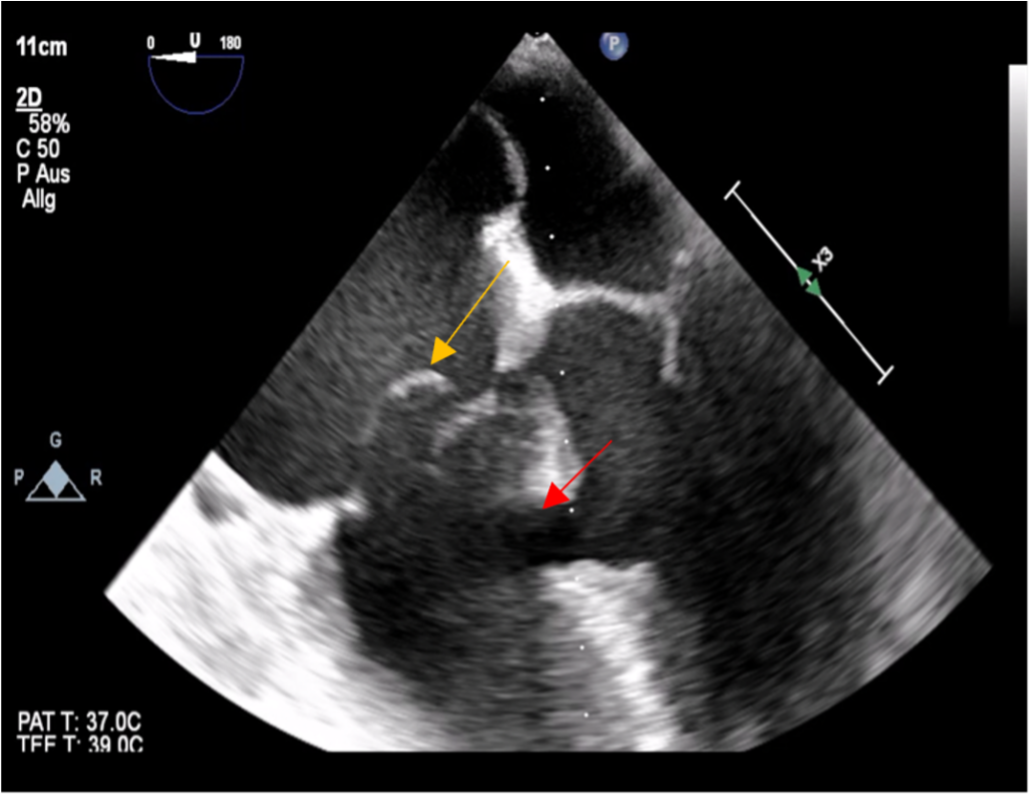 Transatrial repair of a ventricular septal defect and tricuspid valve ...